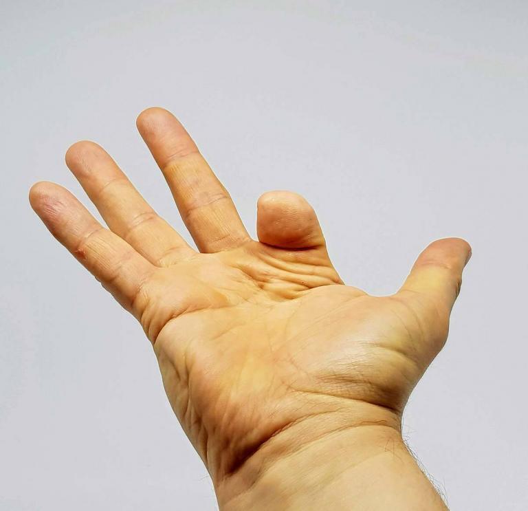 Severed Fingers From a Car Crash